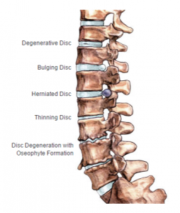 Conditions - Vancouver Spine Doctor